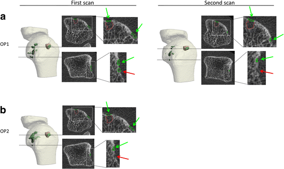 An automated algorithm for the detection of cortical interruptions and its underlying loss of ...