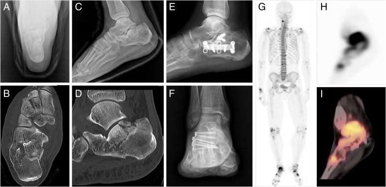 Use of 18F-sodium fluoride bone PET for disability evaluation in ankle ...