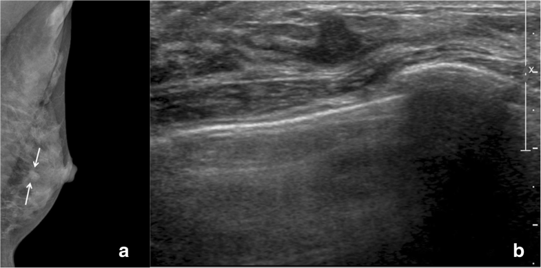 Radial scars/complex sclerosing lesions of the breast: radiologic and ...