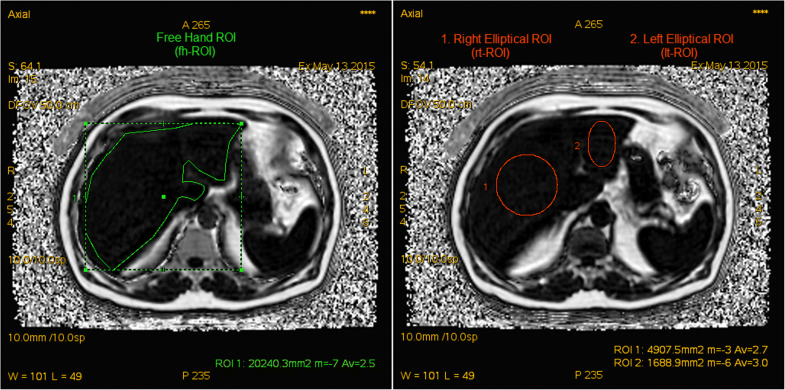 Measuring liver fat fraction with complex-based chemical shift MRI: the ...