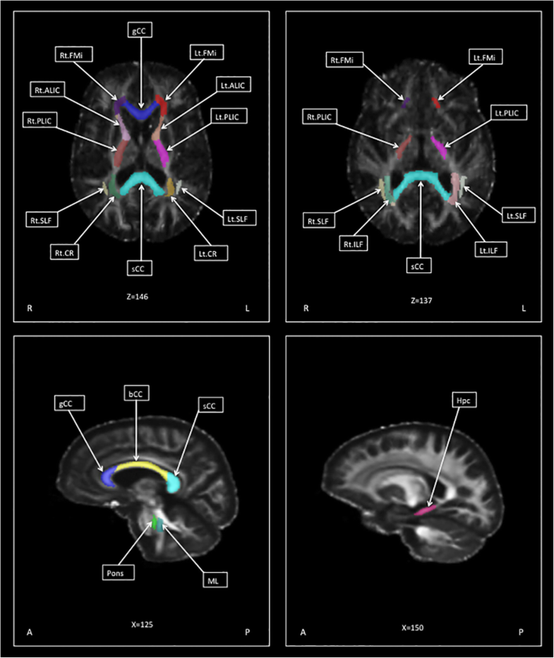 Tract integrity in amyotrophic lateral sclerosis: 6–month evaluation ...