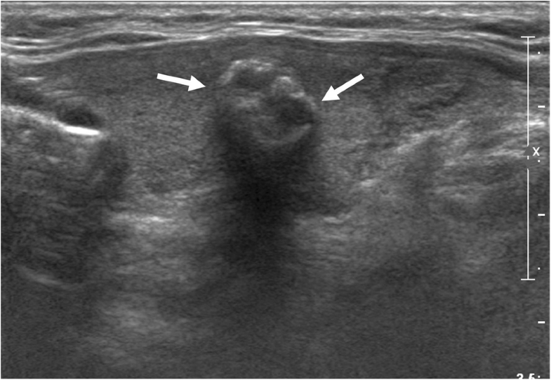 Echogenic foci in thyroid nodules: diagnostic performance with ...