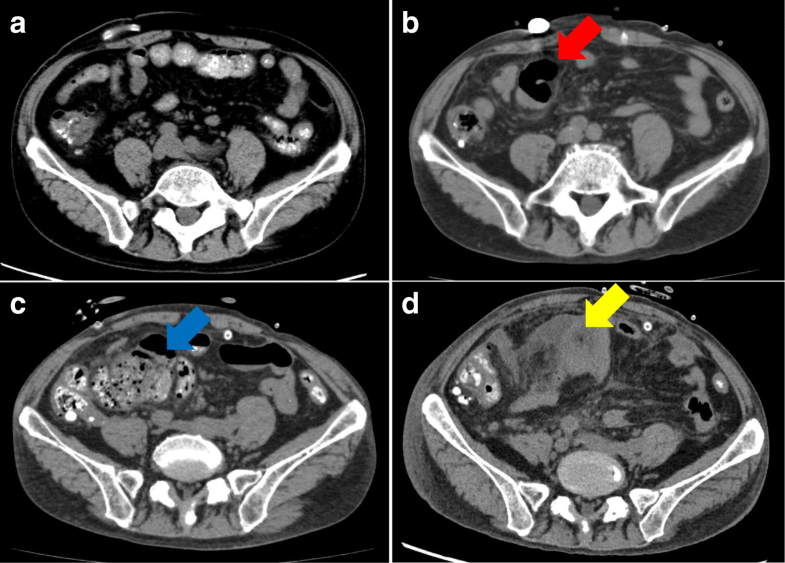 Adhesive intestinal obstruction increases the risk of intestinal ...