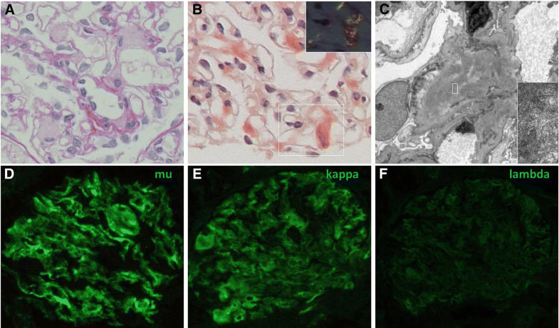 AL amyloidosis with non-amyloid forming monoclonal immunoglobulin ...