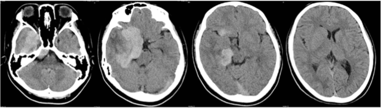Unusual presentation of a skull base mass lesion in sarcoidosis ...
