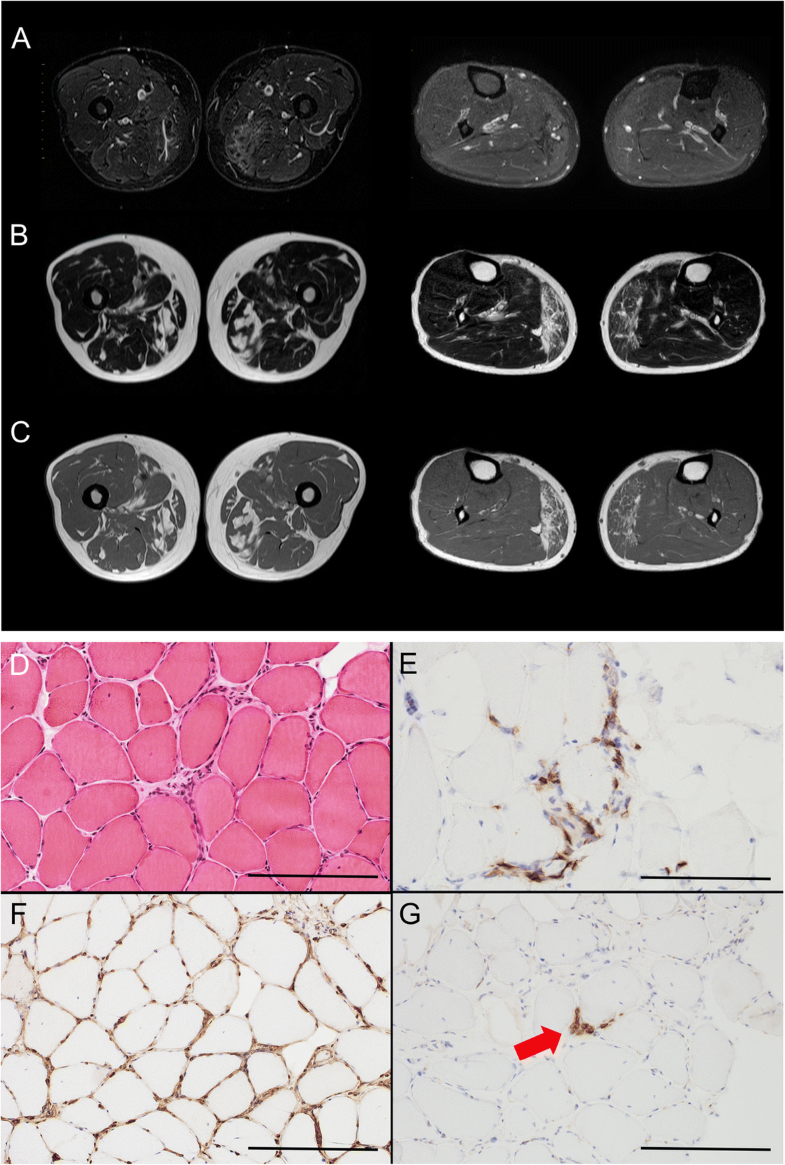 Myalgia caused by chronic myositis associated with plasmacytosis: a ...