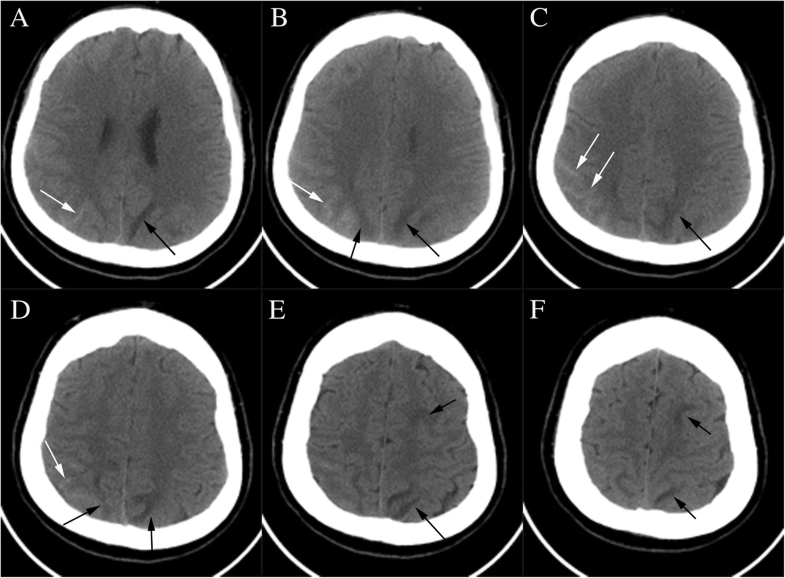 Posterior reversible encephalopathy syndrome complicated with ...