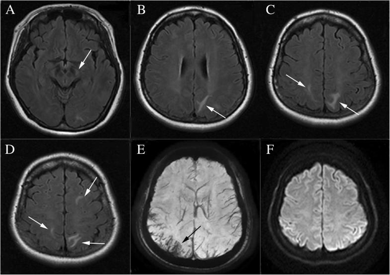 Posterior reversible encephalopathy syndrome complicated with ...