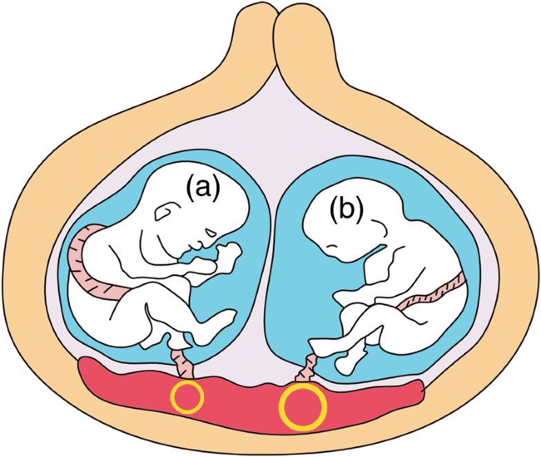 Three-dimensional power Doppler ultrasound evaluation of placental ...