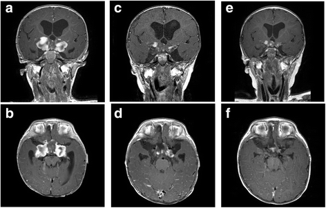 An infant with hyperalertness, hyperkinesis, and failure to thrive: a ...