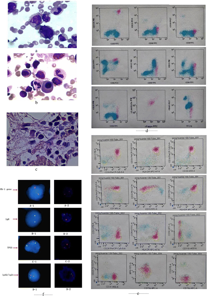 A case of simultaneous occurrence of acute myeloid leukemia and ...