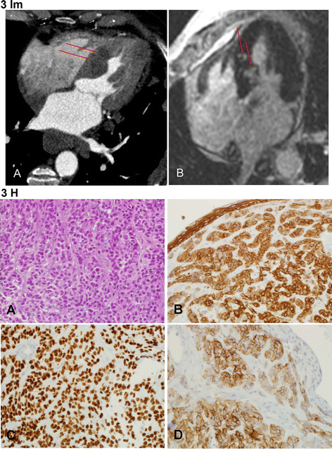 Metastatic cardiac tumors: from clinical presentation through diagnosis ...