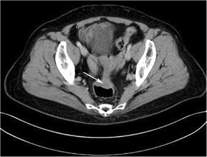 Endometriosis-associated recto-sigmoid cancer: a case report | BMC ...