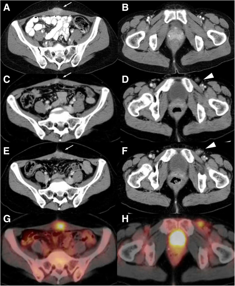 Metachronous metastasis to inguinal lymph nodes from sigmoid colon ...