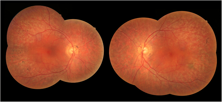 Bilateral cystoid macular edema following docetaxel chemotherapy in a ...