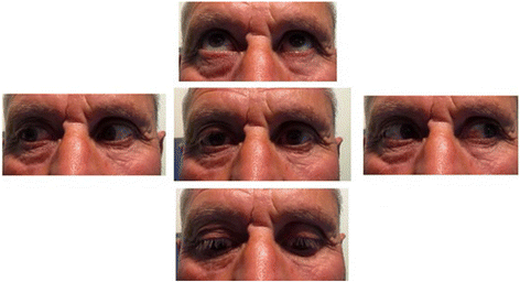 Intraorbital haematoma during a commercial flight: a case report | BMC ...