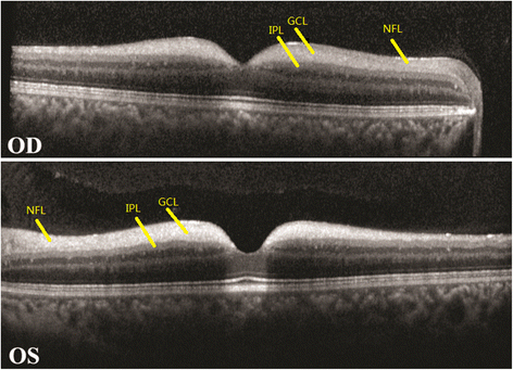 Fundus autofluorescence and optical coherence tomography of a macular ...