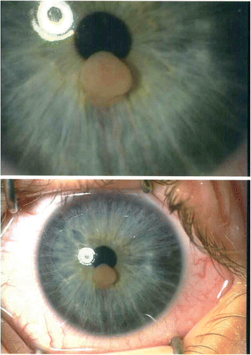 Vascularized solid iris lesion in a 3 year old child: 5 years of follow ...