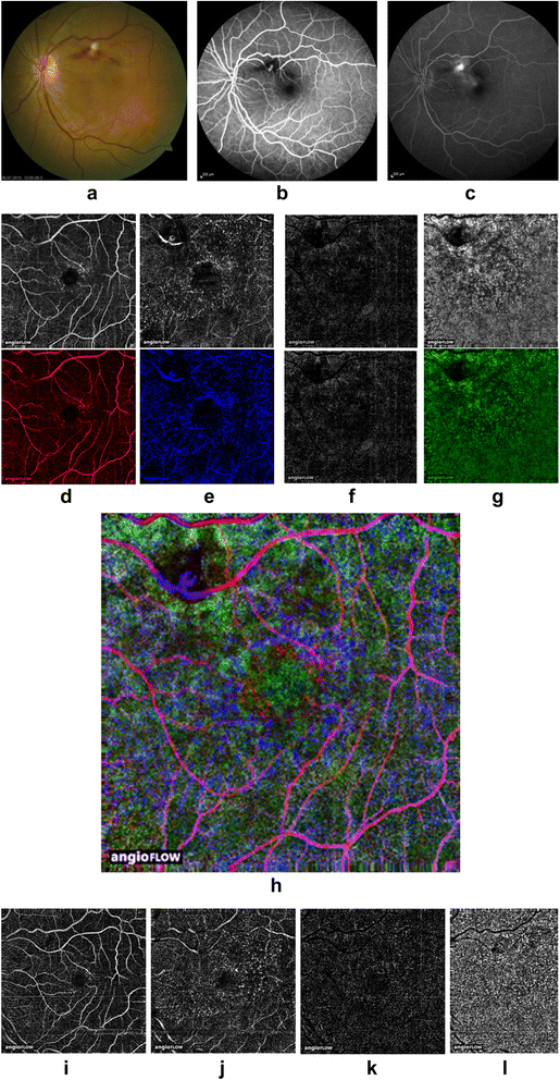 Optical coherence tomography (OCT) angiography findings in retinal ...