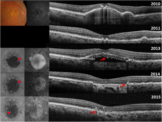 Atypical retinal pigment epithelial defects with retained photoreceptor ...