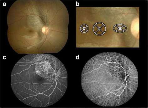 Blood flow velocity and thickness of the choroid in a patient with ...