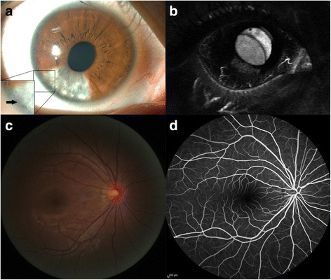 Segmental ischaemic infarction of the iris after autologous fat ...
