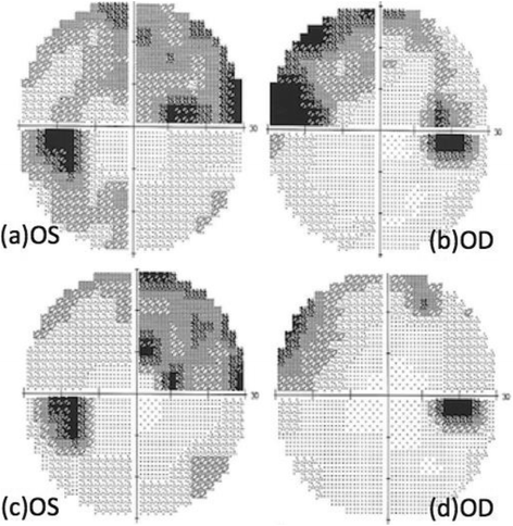 Acute Zonal Occult Outer Retinopathy (AZOOR): a case report of vision ...
