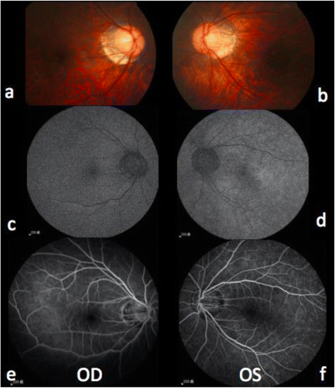 Acute Zonal Occult Outer Retinopathy (AZOOR): a case report of vision ...