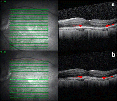 Acute Zonal Occult Outer Retinopathy (AZOOR): a case report of vision ...