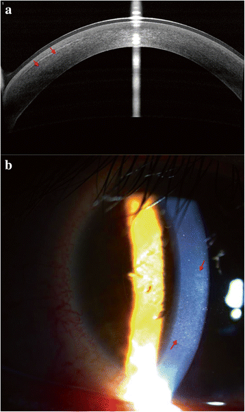 Late-onset diffuse lamellar keratitis 4 years after femtosecond laser ...