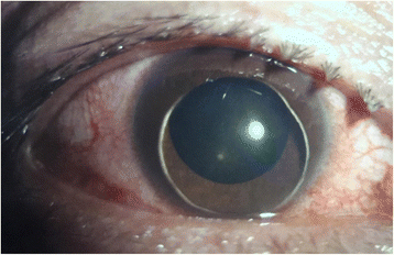 Monocular lens dislocation due to vomiting-a case report | BMC ...