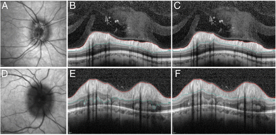 Segmentation error in spectral domain optical coherence tomography ...