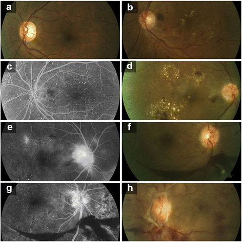 Assessment of visual morbidity amongst diabetic retinopathy at tertiary ...