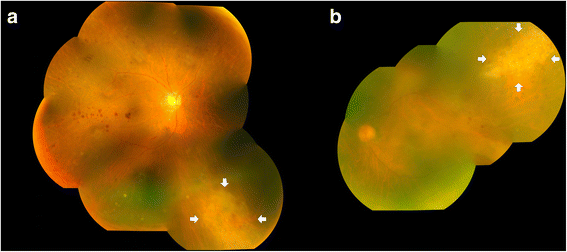 Repeated intraocular crystallization of ganciclovir in one eye after ...