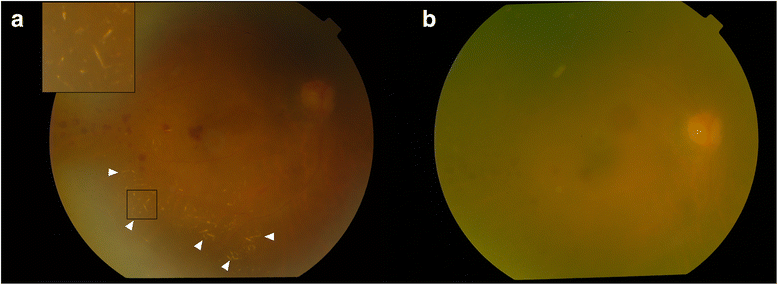 Repeated intraocular crystallization of ganciclovir in one eye after ...