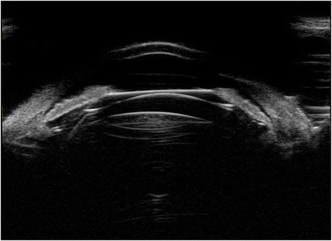 Analysis of intraocular positions of posterior implantable collamer ...