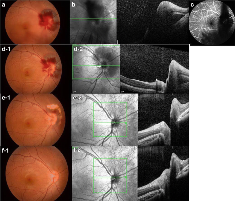 Intrapapillary hemorrhage with concurrent peripapillary and vitreous ...