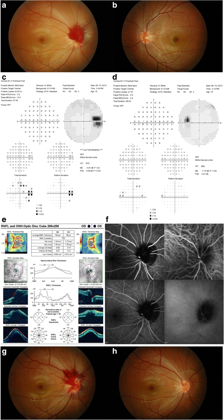 Intrapapillary hemorrhage with concurrent peripapillary and vitreous ...