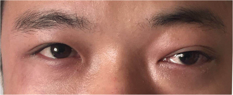 Post-traumatic right carotid-cavernous fistula resulting in symptoms in ...