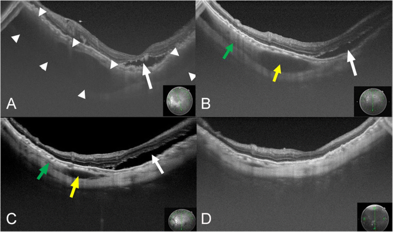Suprachoroidal hemorrhage followed by swept-source optical coherence ...