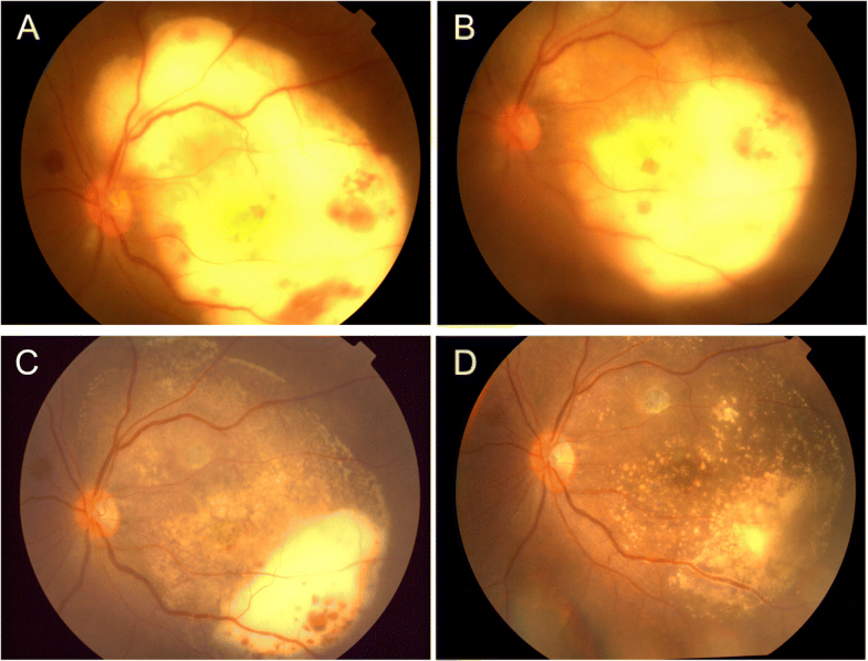 Disseminated Nocardiosis with subretinal abscess in a patient with ...