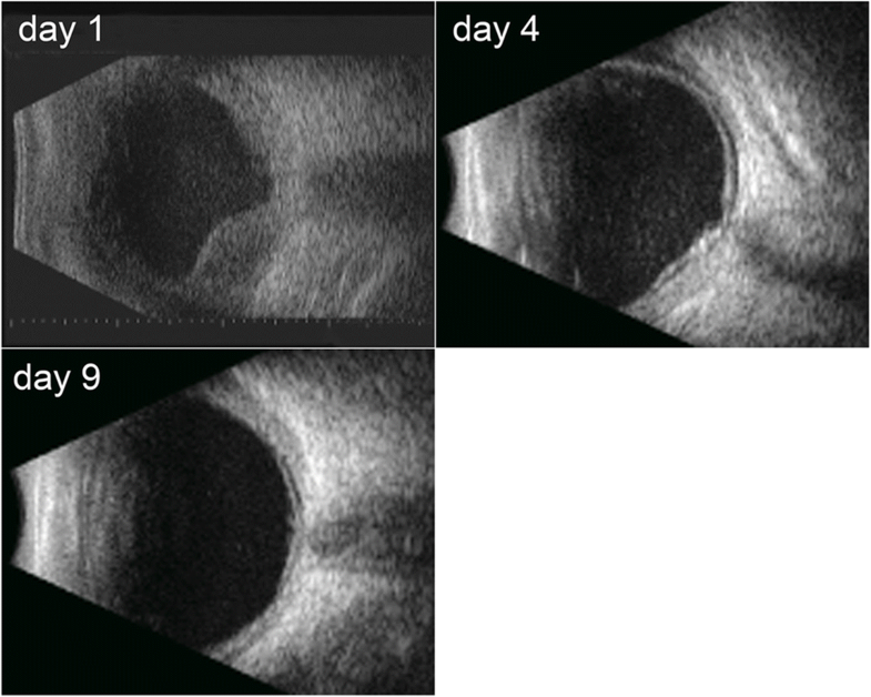 Successful treatment of endogenous endophthalmitis with extensive ...