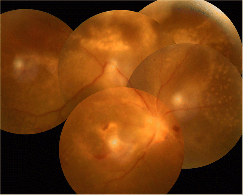 Successful treatment of endogenous endophthalmitis with extensive ...