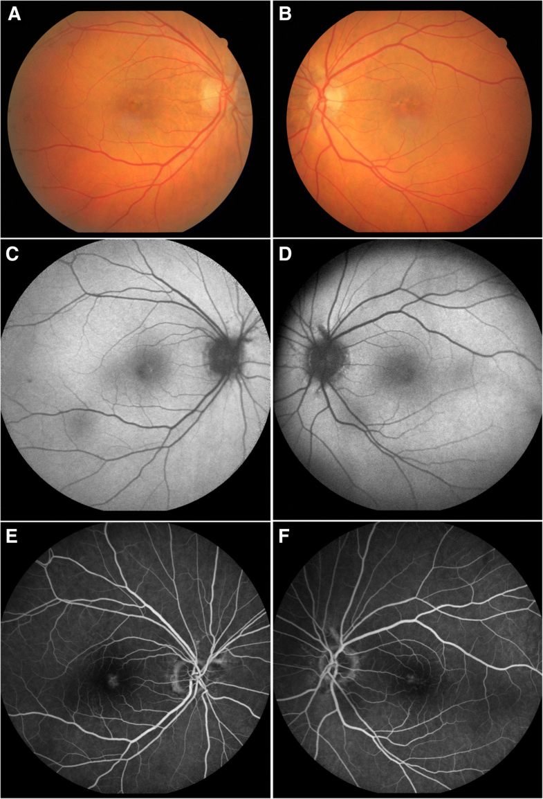 Pattern dystrophies in patients treated with deferoxamine: report of ...