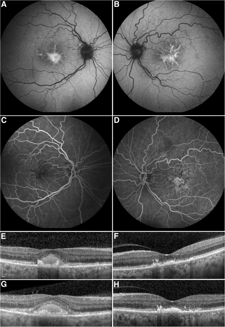 Pattern dystrophies in patients treated with deferoxamine: report of ...