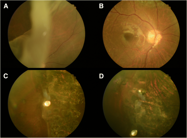 Management of Giant Retinal Tear with microincision vitrectomy and ...