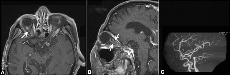 Giant cell arteritis presenting as bilateral anterior ischemic optic ...