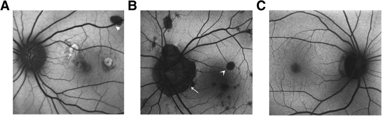 Imageology features of different types of multifocal choroiditis | BMC ...