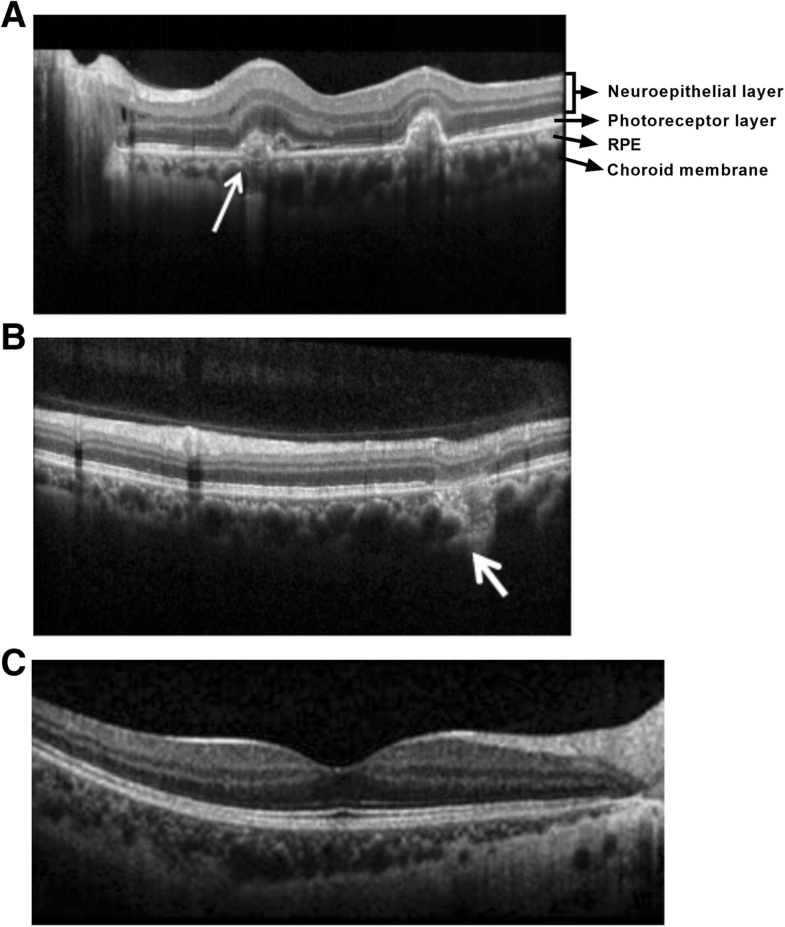 Imageology features of different types of multifocal choroiditis | BMC ...