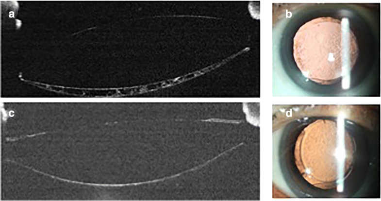 Posterior capsular opacification comparison between morphology and ...